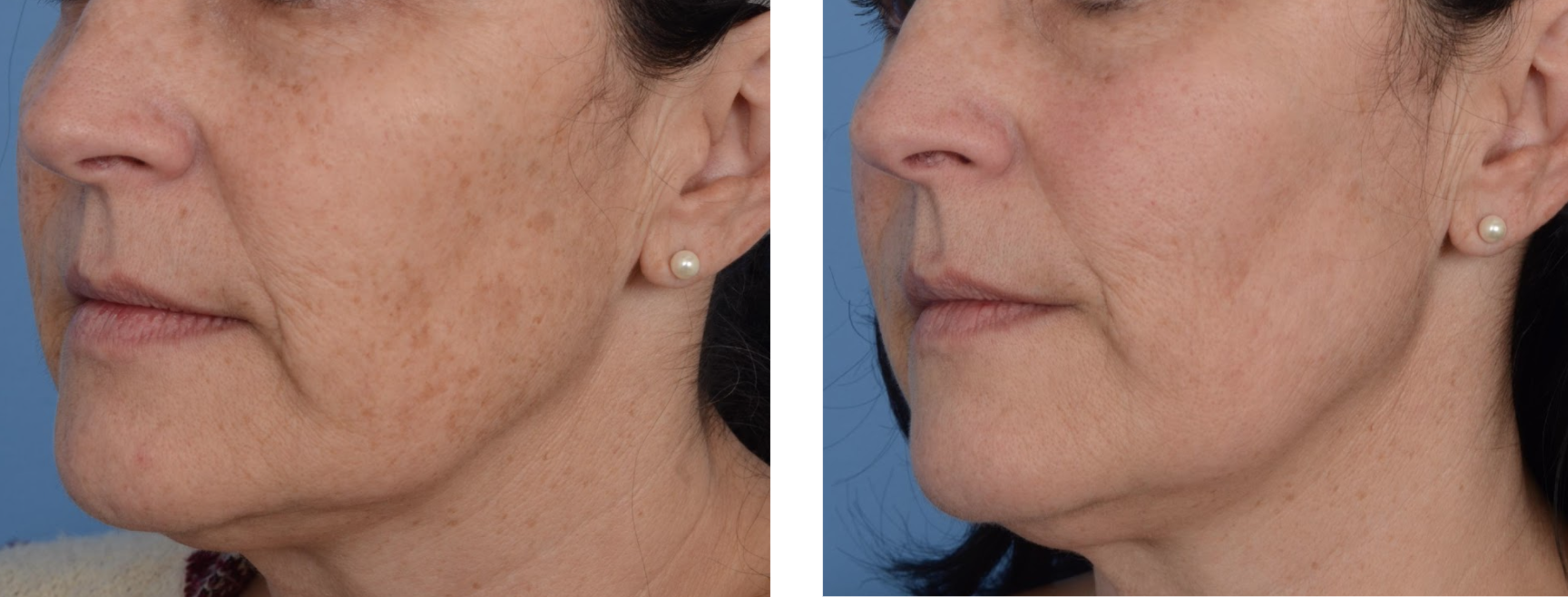 FotoFacial RF (IPL+RF) - Rejuvayou