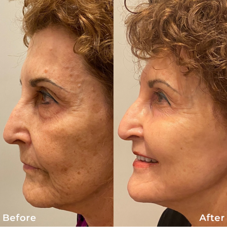 What is Phoenix-15 CO2 Fractional Laser Resurfacing - Rejuvayou
