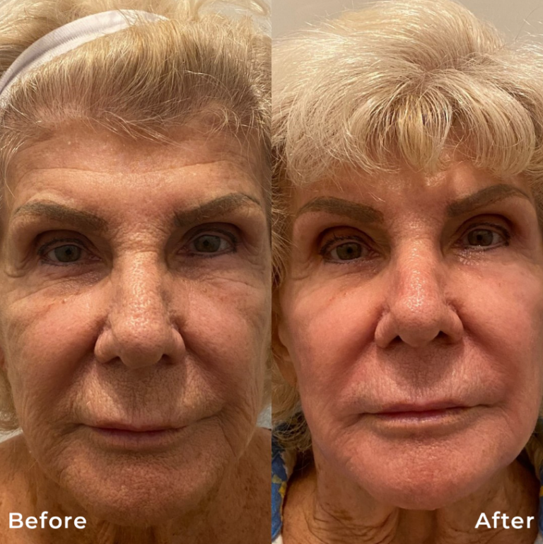 What is Phoenix-15 CO2 Fractional Laser Resurfacing - Rejuvayou